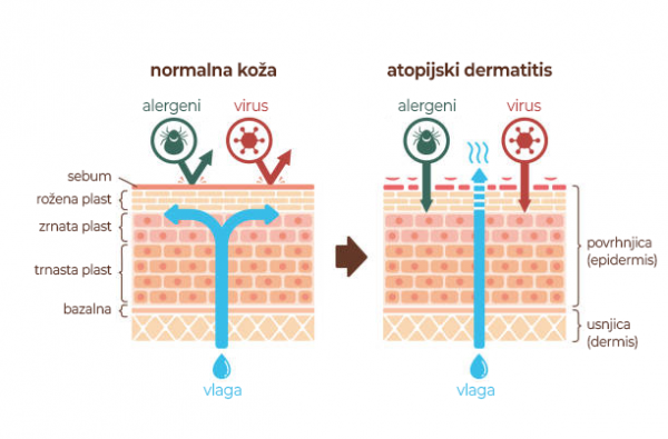 Atopijski dermatitis - kako ga uspešno obvladati? - DK Glowy