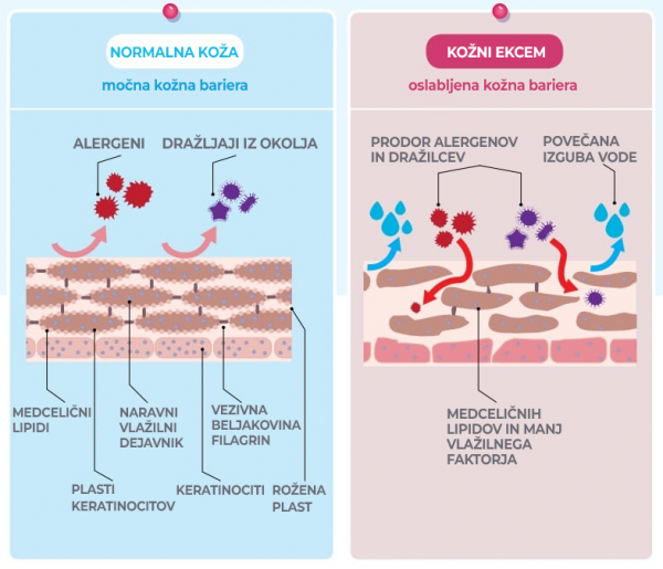 Atopijski dermatitis - kako ga uspešno obvladati? - DK Glowy