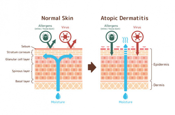 5 Things You Can Do to Control Atopic Dermatitis - DK Glowy