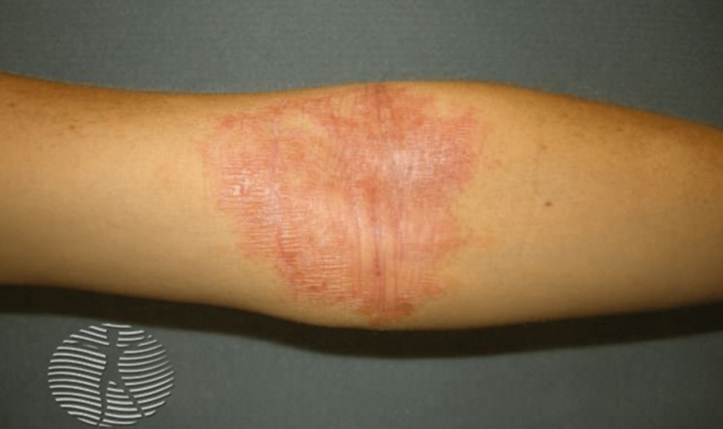 Atopijski dermatitis in atopijska koža - DK Glowy